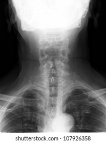 Chest Xray Show Acute Respiratory Distress Stock Photo (Edit Now ...