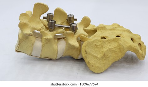5,247 Bone screws Images, Stock Photos & Vectors | Shutterstock