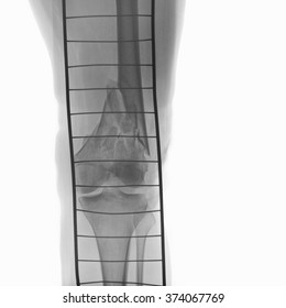 231 Splinter Bone Images, Stock Photos & Vectors | Shutterstock