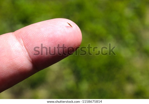 783 afbeeldingen voor Skin splinter: afbeeldingen, stockfoto‘s en ...