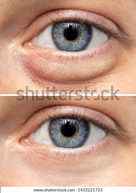 A split screen view on the eyes of a young Caucasian girl, one show ...