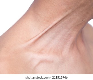 Scar On Male Body After Surgery Stock Photo (Edit Now) 1385725103