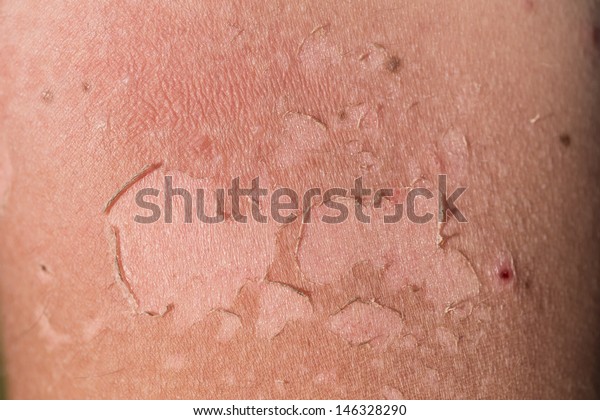 Sunburn Stock Photo (Edit Now) 146328290