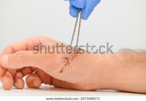 Suture Wound On Hand Dermatology Procedure Stock Photo (Edit Now ... Suture Wound On Hand Dermatology Procedure Stock Photo (Edit Now ...