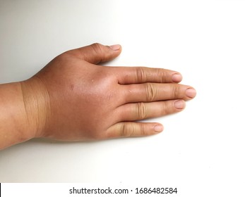 Swollen Hands Closeup Bug Bite Skin Stock Photo 1686482584 | Shutterstock