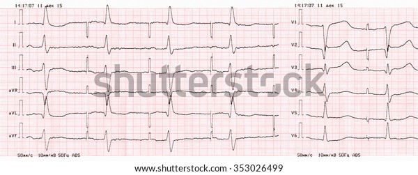 Tape Ecg Artificial Pacemaker Rhythm Atrial Stock Photo 353026499 ...