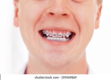 1,356 Handsome man braces teeth Stock Photos, Images & Photography ...