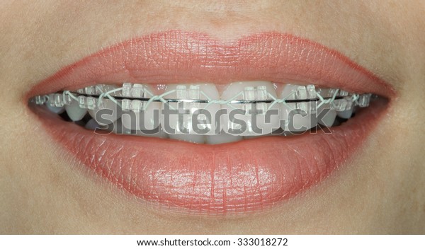 Teeth Ceramic Braces Stock Photo (Edit Now) 333018272
