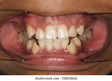 Teeth Checking Before Braces Operation Done Stock Photo 558534652 ...