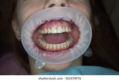 41 Lip retraction Images, Stock Photos & Vectors | Shutterstock