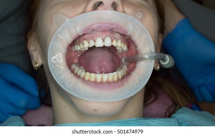 41 Lip retraction Images, Stock Photos & Vectors | Shutterstock