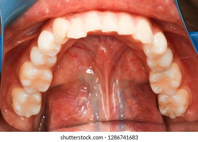 Dental Calculus Lower Anterior Tooth Periodontitis Foto Stok 1683481240 ...