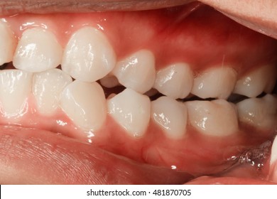 Gingival Recession Known Receding Gums Exposure Stock Photo 2128485983 ...
