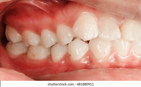 Edge Edge Bite Occlusion Front Teeth Foto Stok 2041939151 | Shutterstock