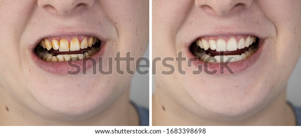 Teeth Man Before After Bleaching Dentist Stock Photo 1683398698 ...