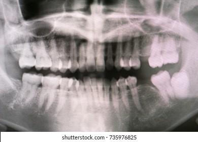 481 X ray teeth missing Images, Stock Photos & Vectors | Shutterstock