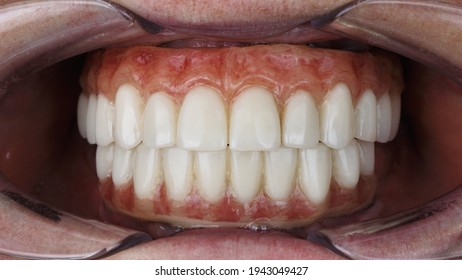 1,028 Temporary Denture Images, Stock Photos & Vectors | Shutterstock