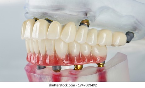 1,028 Temporary Denture Images, Stock Photos & Vectors | Shutterstock