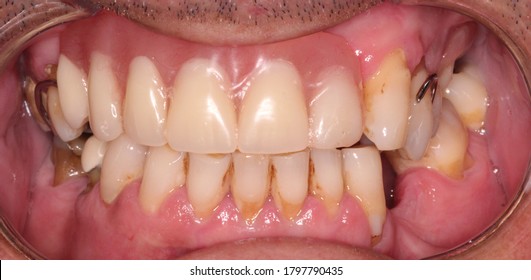 118 Temporary occlusion 이미지, 스톡 사진 및 벡터 | Shutterstock