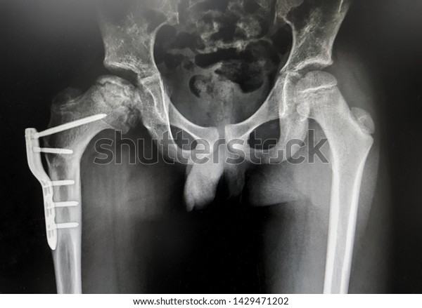 This Xray Shown Corrective Osteotomy Proximal Stock Photo (Edit Now ...