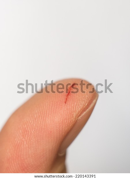Thumb Cut Wound Stock Photo 220143391 | Shutterstock