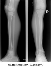 Xray Image Old Fraktur Tibia Fibula Stock Photo (Edit Now) 2075658196