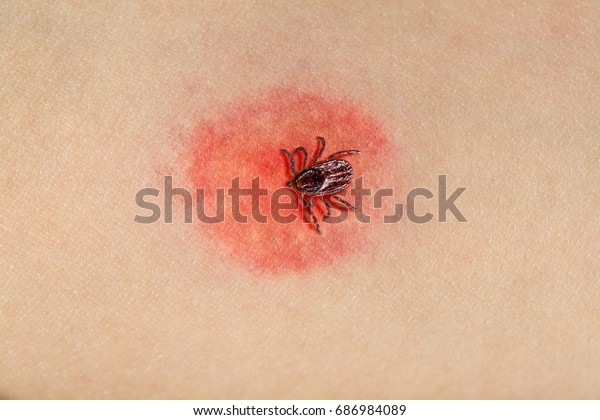 Tick Biting Human Skin Causing Dangerous Stock Photo (Edit Now) 686984089