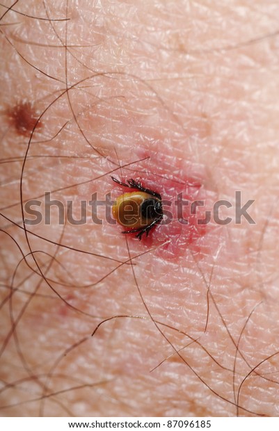 Tick Embedded Human Skin Causing Slight Stock Photo (Edit Now) 87096185
