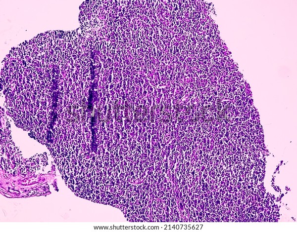 Tissue Right Axillary Lymph Node Histology Foto stock 2140735627 ...