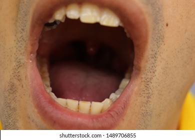 Tonsilities Common Throat Problem Both Woman Stock Photo (Edit Now ...