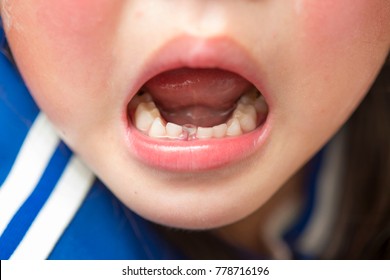 891 Asian child missing teeth Images, Stock Photos & Vectors | Shutterstock
