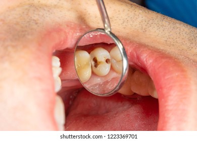 Dark Detached Toenail Due Injury Coming Stock Photo 1920855410 ...