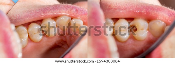 Two Chewing Side Teeth Upper Jaw Stock Photo 1594303084 | Shutterstock