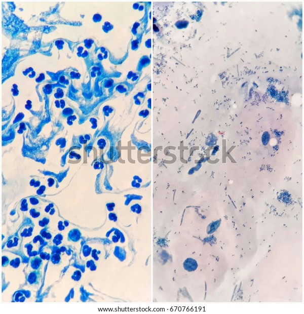 Two Pattern Smear Sputum Specimen Under Stock Photo (Edit Now) 670766191