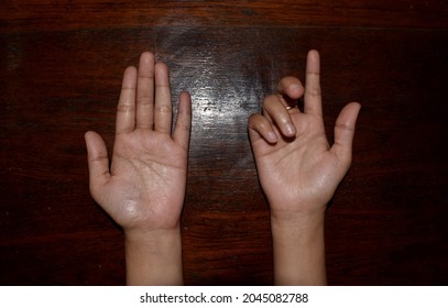 64 Abnormal Extension Images, Stock Photos & Vectors | Shutterstock