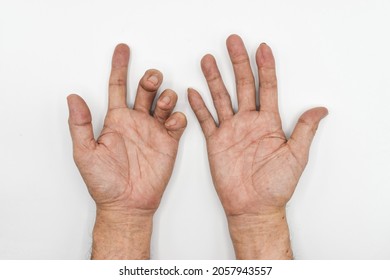 64 Abnormal Extension Images, Stock Photos & Vectors | Shutterstock