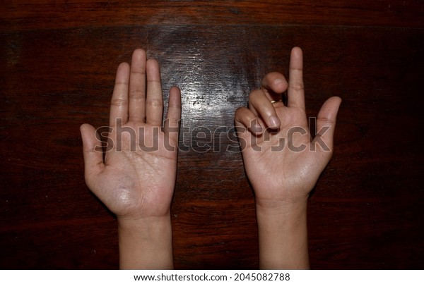 Ulnar Claw Hand Compared Normal Hand Stock Photo 2045082788 | Shutterstock