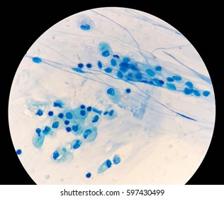 Стоковая фотография 1598603551: Atypical Squamous Cell Undetermined ...