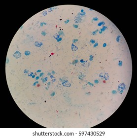 Modified Acid Fast Stain Positive Nocardia ภาพสต็อก 1386200798 ...
