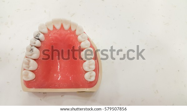 Upper Arch Teeth Model Showing Filled Stock Photo 579507856 | Shutterstock