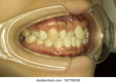 Amalgam Restoration Lower Molar Teeth Foto Stok 716691130 | Shutterstock