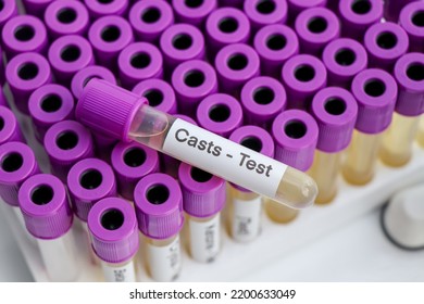 Urine Samples Testing Casts Laboratory Urine Stock Photo 2200633049 ...