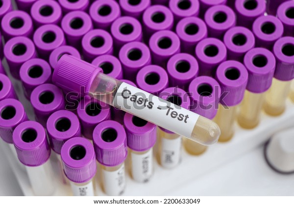 Urine Samples Testing Casts Laboratory Urine Stock Photo 2200633049 ...