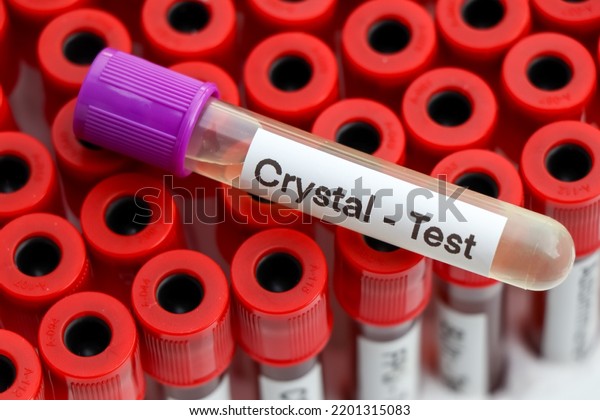 Urine Samples Testing Crystal Laboratory Urine Stock Photo 2201315083 ...