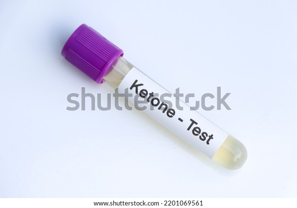 Urine Samples Testing Ketones Laboratory Urine Stock Photo 2201069561 ...