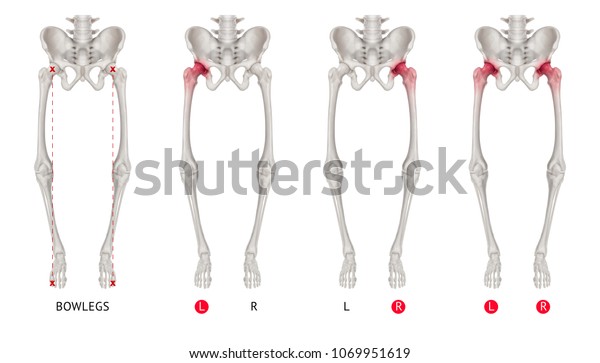 Varus Alignment Leg Bowlegs Bone Collection Stock Photo (Edit Now ...