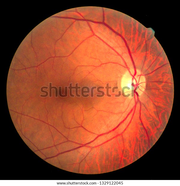 View Inside Human Eye Disorders Showing Stock Photo (Edit Now) 1329122045