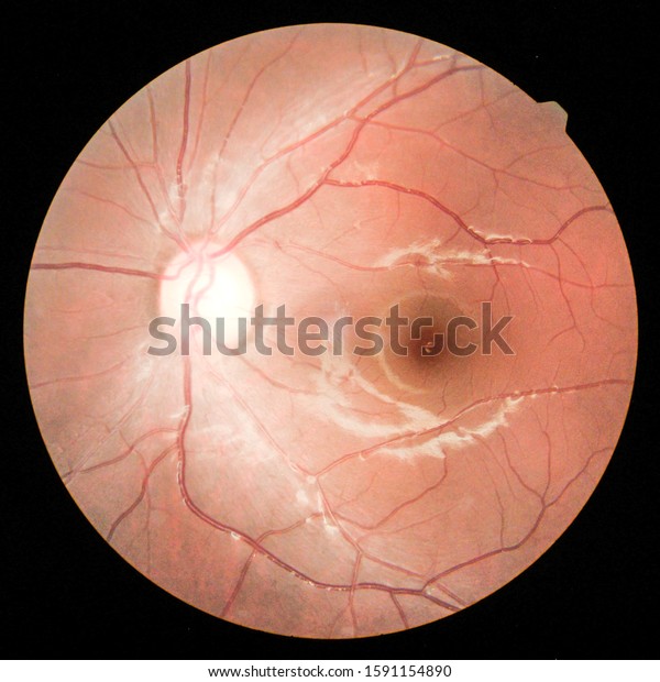 View Inside Human Eye Disorders Showing Stock Photo 1591154890 ...