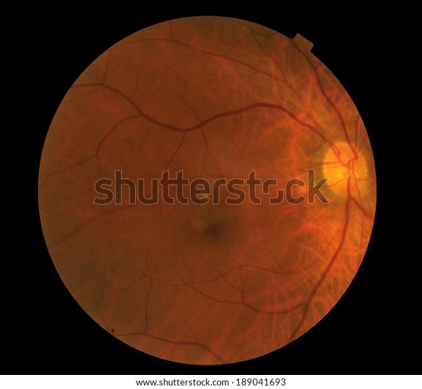 View Inside Human Eye Disorders Showing Stock Photo 189041693 ...