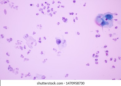 View Microscopic Abnormal Human Cervix Cellssquamous Stock Photo ...